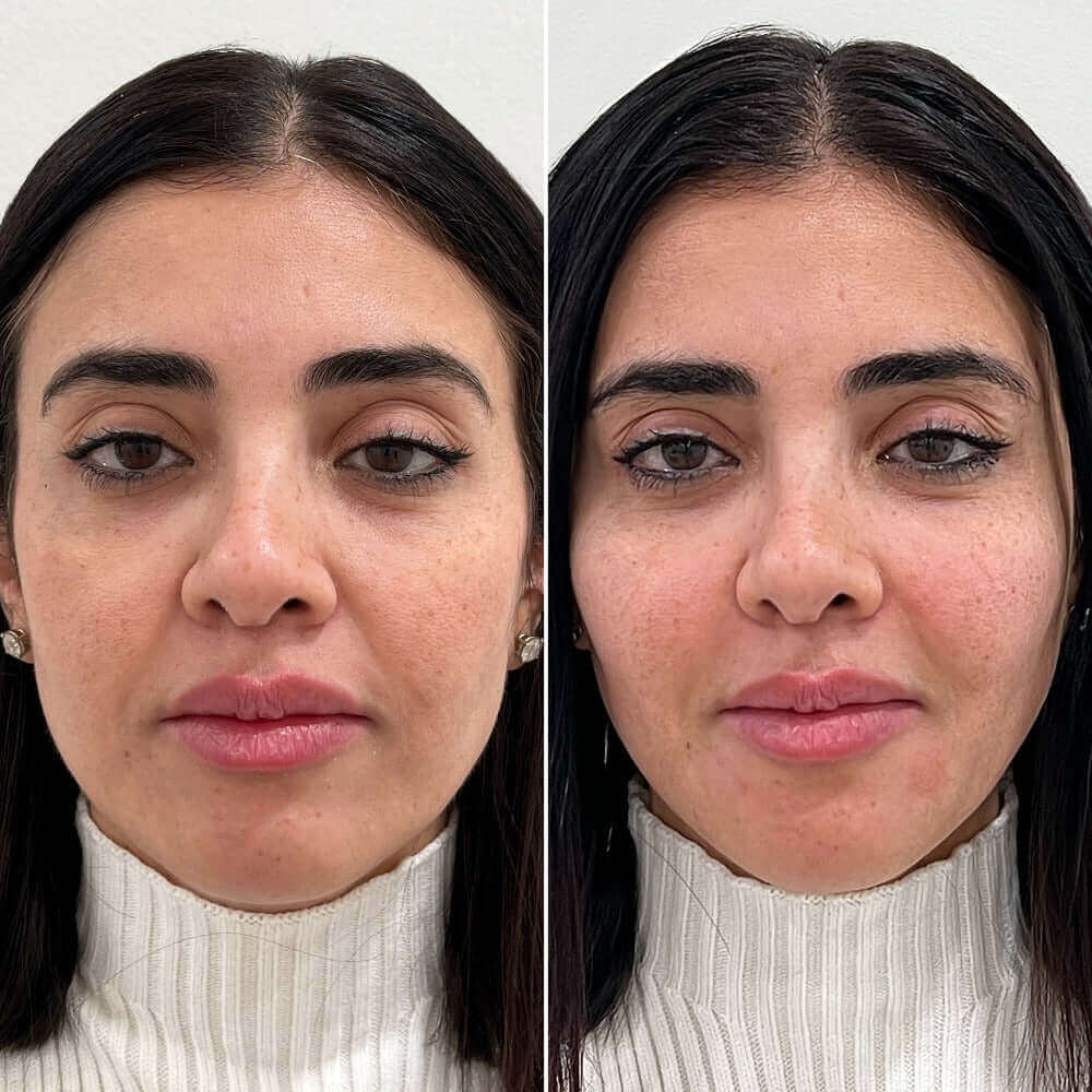 FaceFix: Sculptra | BeautyFix MedSpa - (212) 366-4787