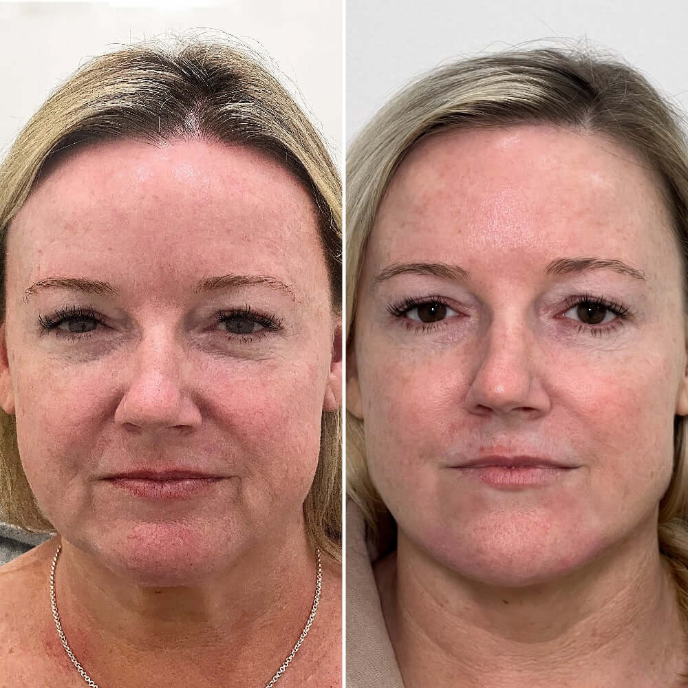 FaceFix: Sculptra | BeautyFix MedSpa - (212) 366-4787