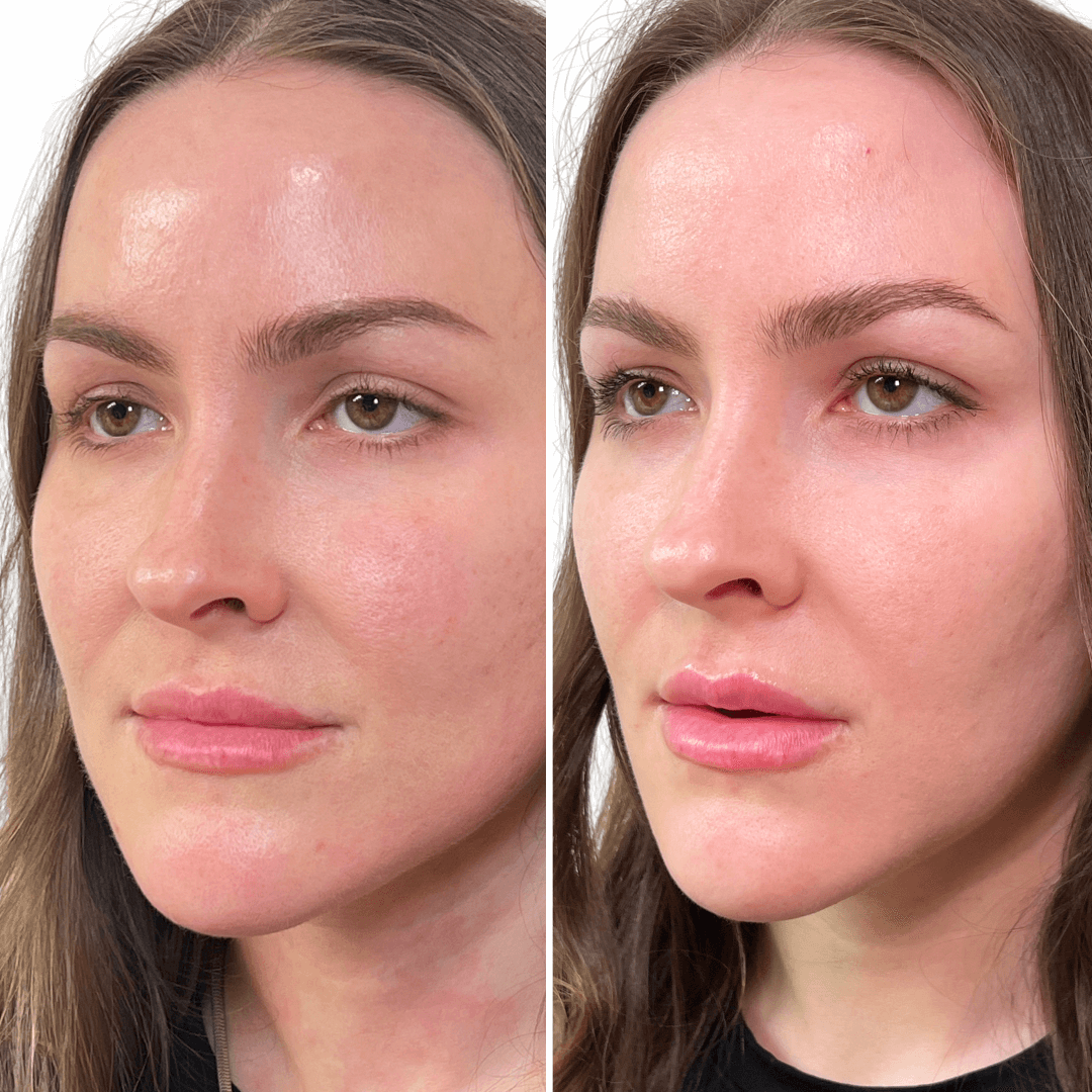 FaceFix: Korean Botox Facial | BeautyFix MedSpa - (212) 366-4787