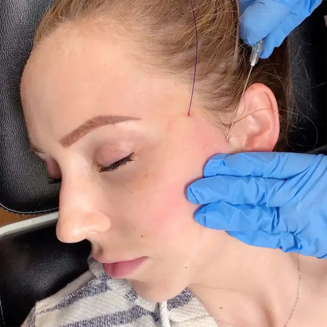 FaceFix: ThreadLift | BeautyFix MedSpa - (212) 366-4787