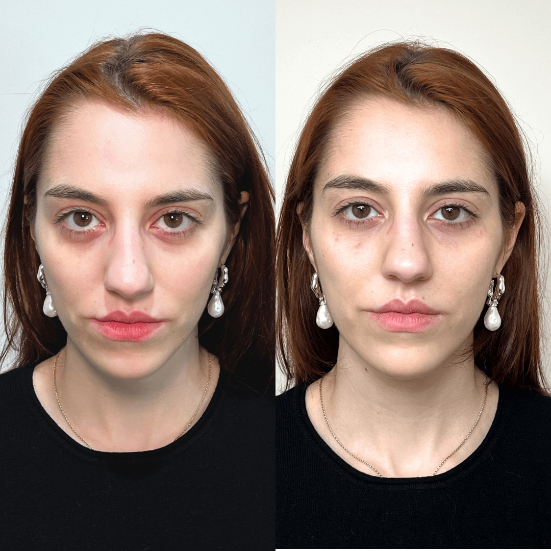 SkinFix: Plasma Rich Fibrin (PRF) | BeautyFix MedSpa Upper East Side