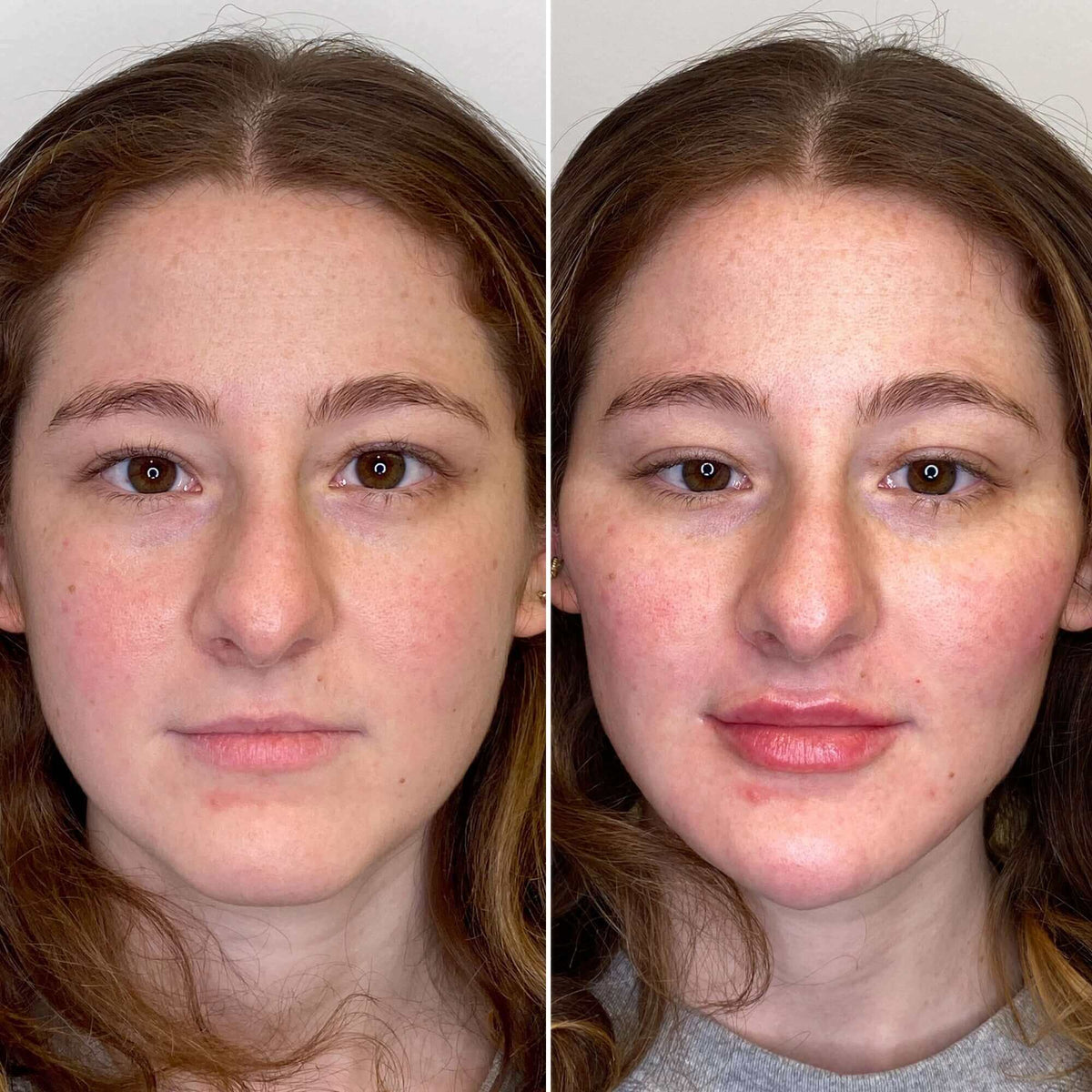 Revitalize Your Look with FaceFix Liquid Face Lift