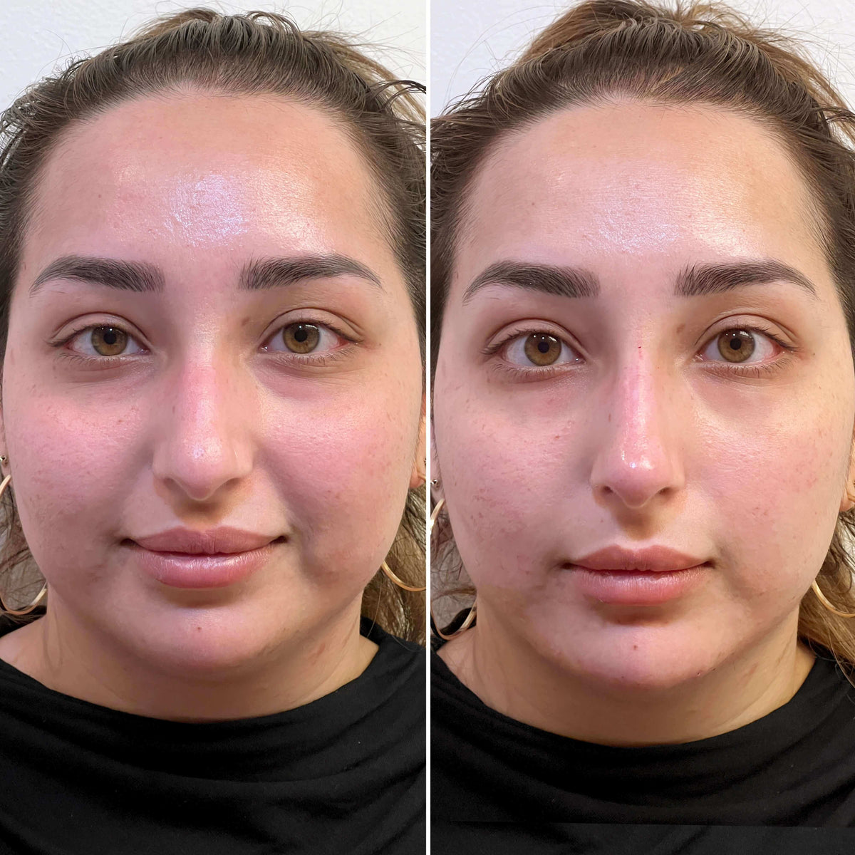 NoseFix: Slimming Treatment – Non-Surgical Nose Job