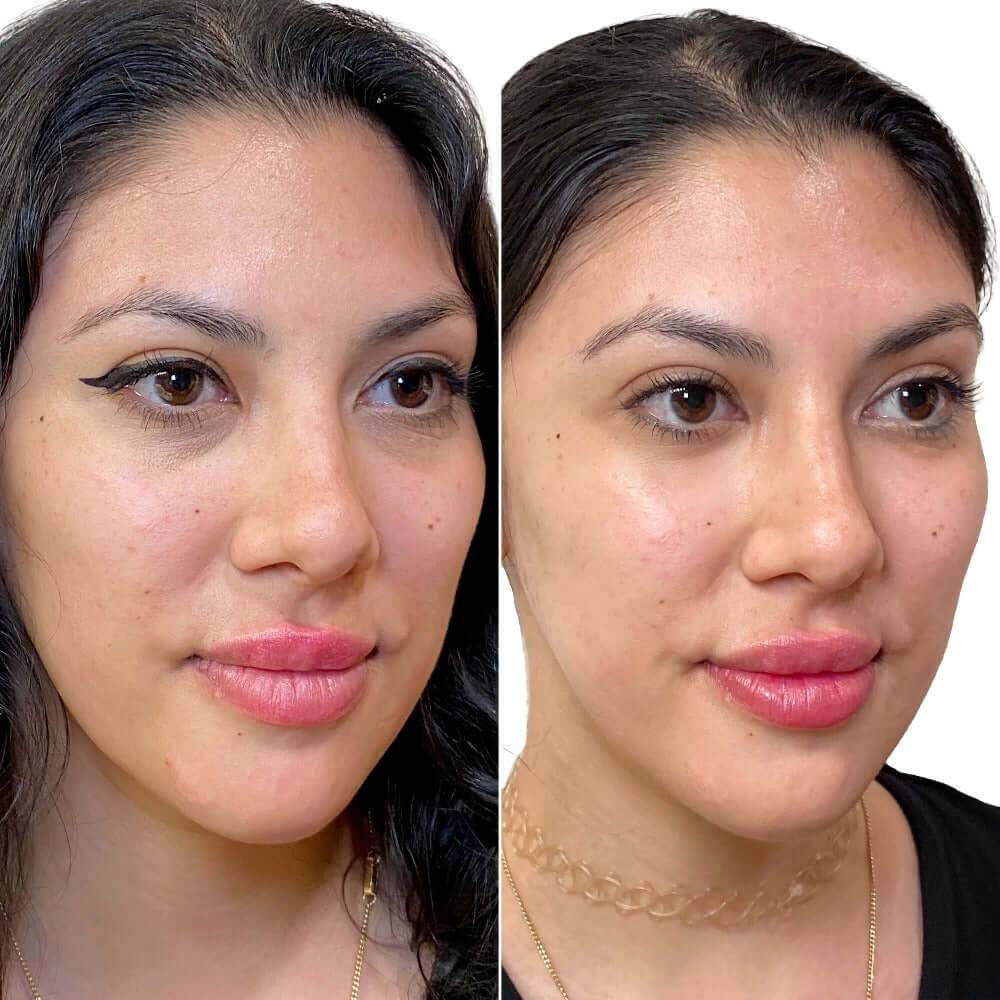 FaceFix: SkinVive (2 Syringes) | BeautyFix MedSpa in NY, CT and FL