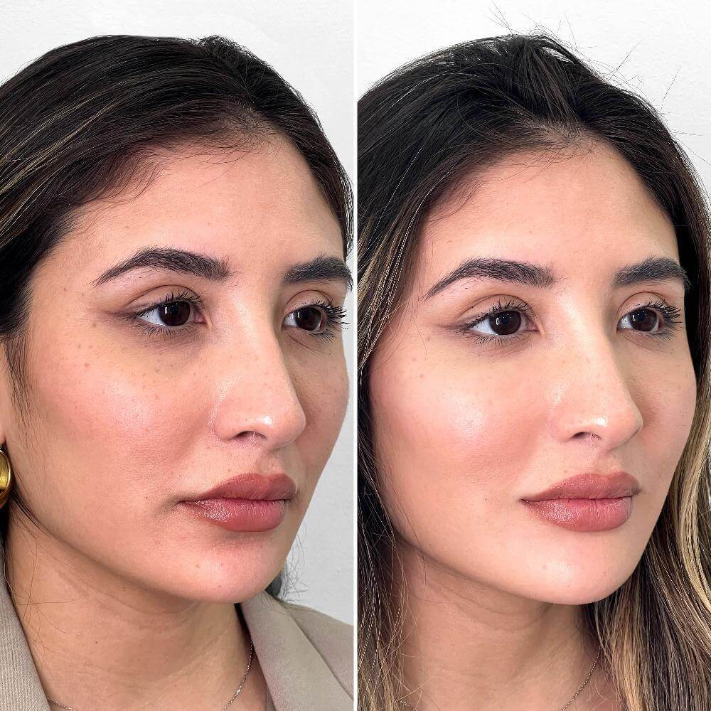 SkinFix: Microneedling | BeautyFix MedSpa - (212) 366-4787