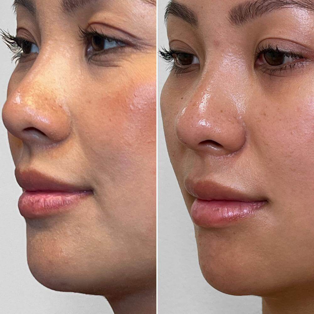 FaceFix: Rejuran Salmon DNA | BeautyFix MedSpa in NY, CT, FL