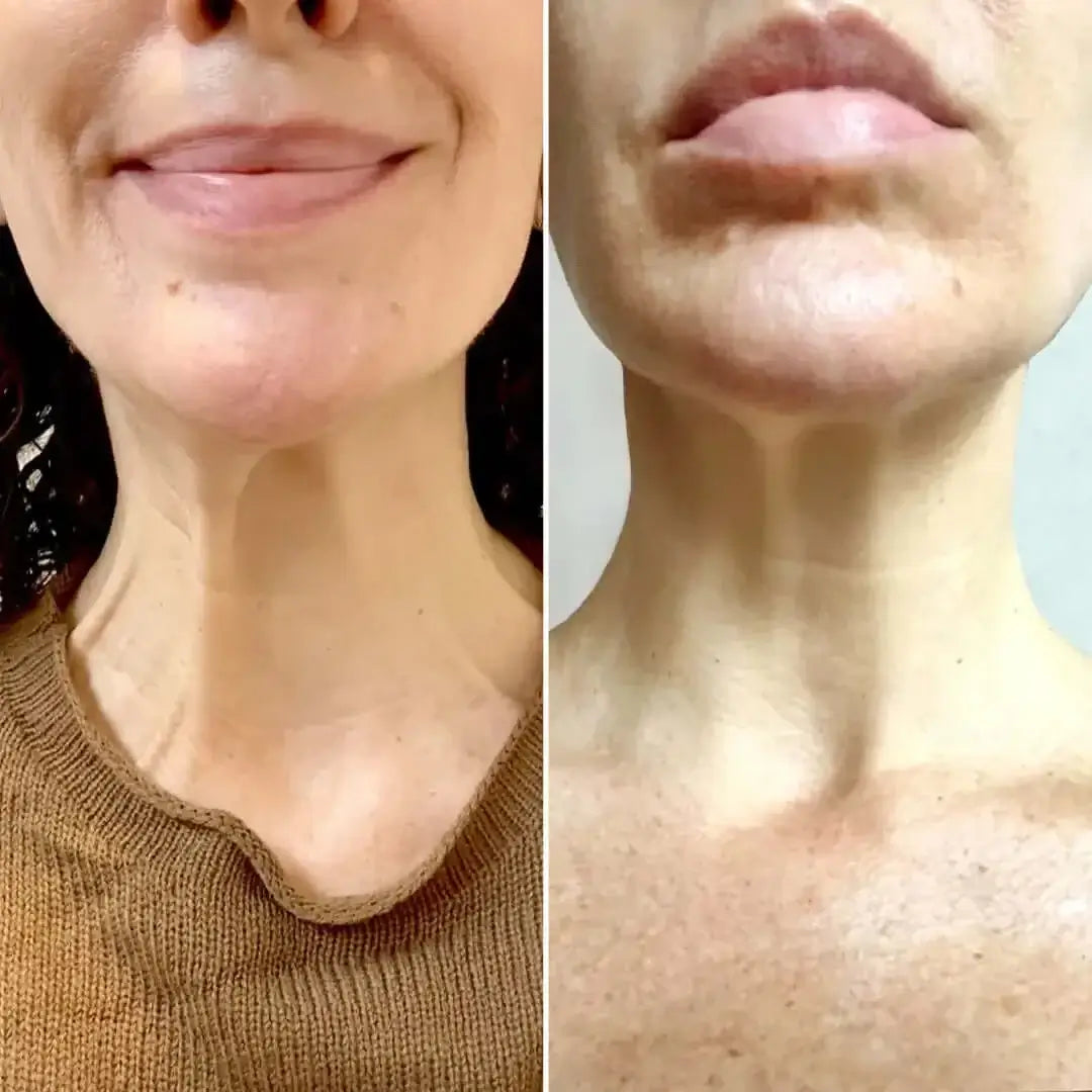 NeckFix: Filler | BeautyFix MedSpa - (212) 366-4787